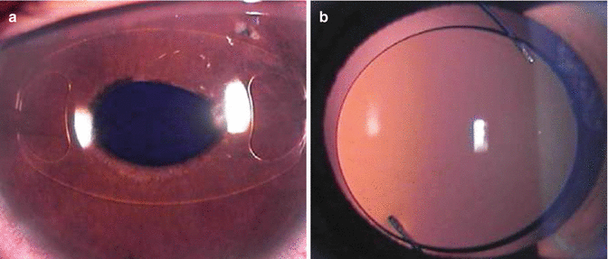 Ectopia Lentis in Children | Obgyn Key
