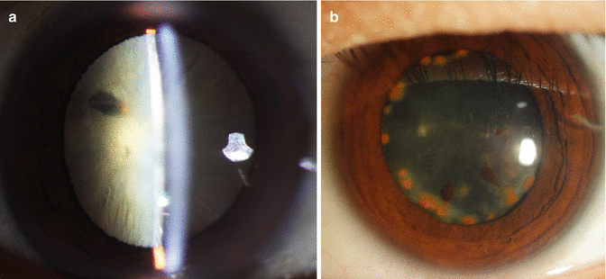 Lens Trauma in Children | Obgyn Key