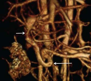 The meso-Rex shunt | Obgyn Key