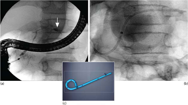 Pancreatic trauma | Obgyn Key