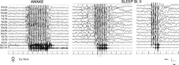 Age: Epilepsy With Myoclonic Absences and Epilepsy With Eyelid ...