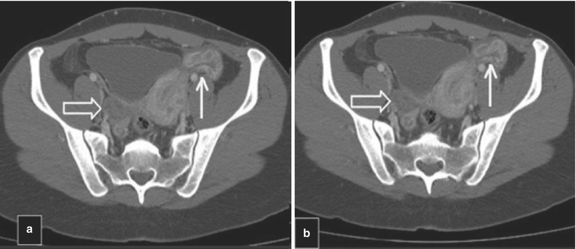 Pelvic Inflammatory Disease | Obgyn Key