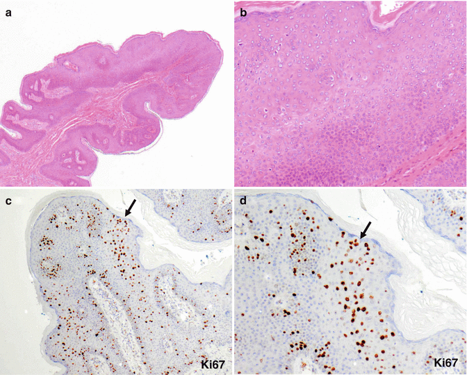 Benign Lesions of the Cervix | Obgyn Key