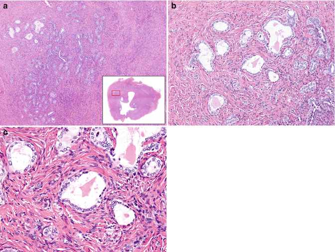 Benign Lesions of the Cervix | Obgyn Key