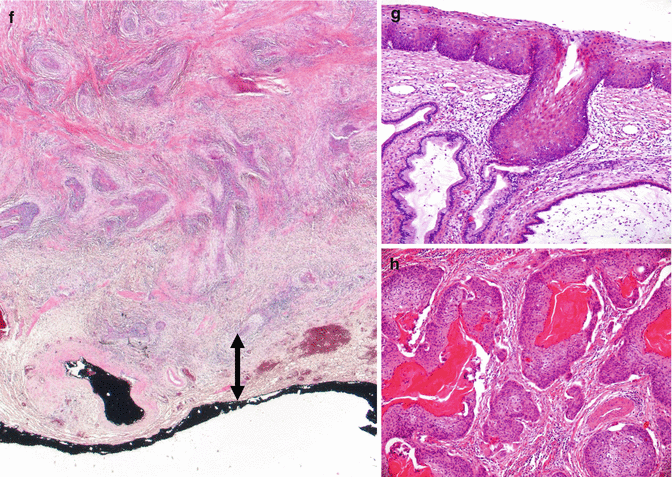 Squamous Cell Carcinoma of the Cervix | Obgyn Key