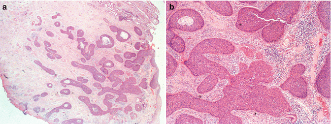 Squamous Cell Carcinoma of the Cervix | Obgyn Key