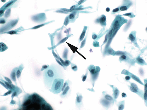 Endocervical Adenocarcinoma In Situ/Cervical Glandular Intraepithelial ...