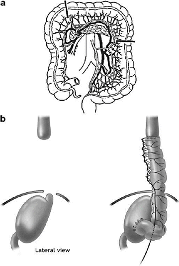 Esophageal Replacement Surgery in Children | Obgyn Key