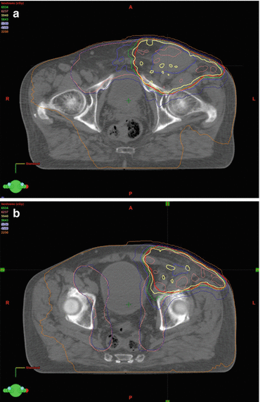 Malignant Inguinal Adenopathy: Considerations for the Radiation ...
