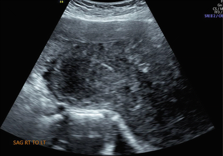 The Cervical Fibroid | Obgyn Key