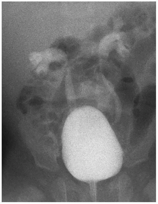Pediatric Genitourinary Tract | Obgyn Key