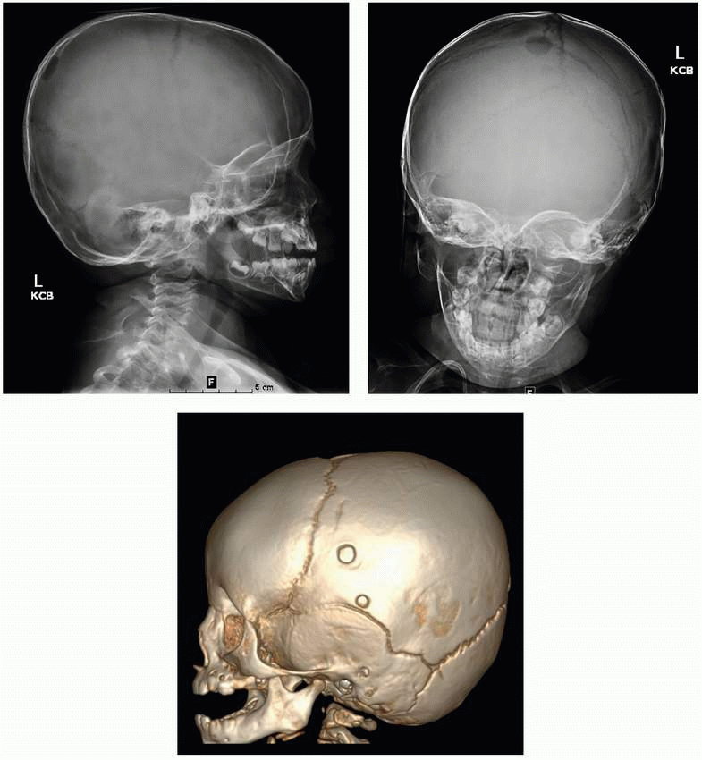 Pediatric Neuroradiology | Obgyn Key