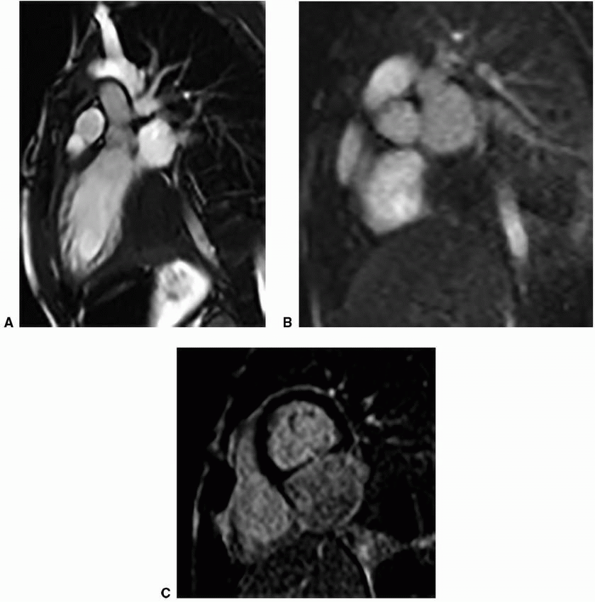 Pediatric Cardiac Radiology | Obgyn Key