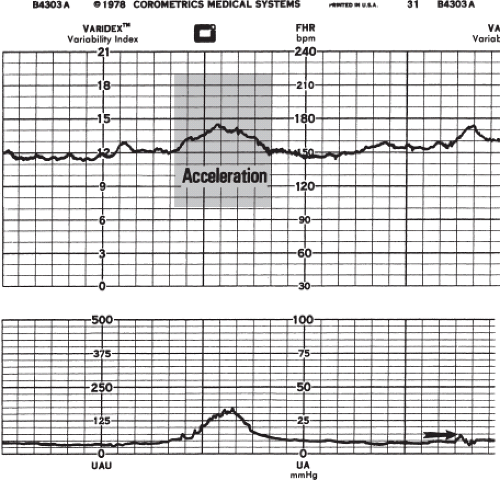 Intrapartum Electronic Fetal Monitoring | Obgyn Key