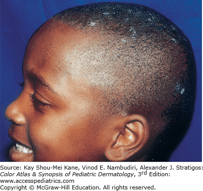 CUTANEOUS FUNGAL INFECTIONS | Obgyn Key