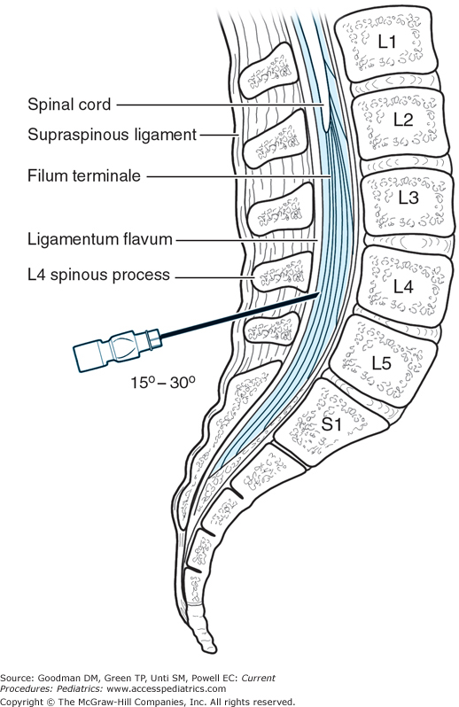 Lumbar Puncture | Obgyn Key