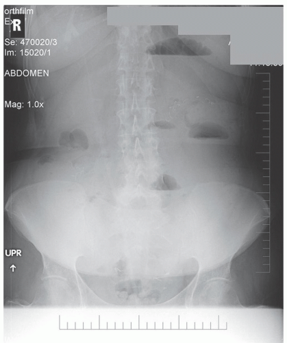 Bowel Obstruction | Obgyn Key