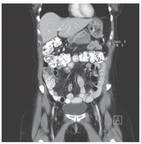 Bowel Obstruction | Obgyn Key