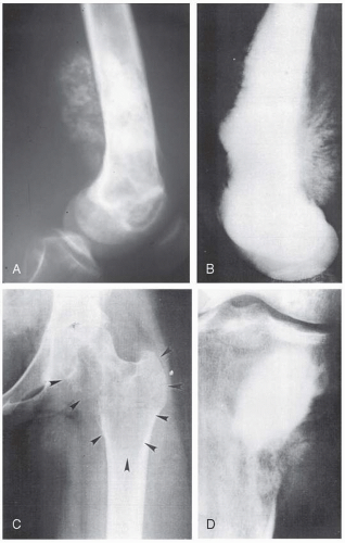 Pediatric Orthopedic Tumors | Obgyn Key