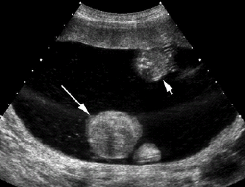 Complications of Multiple Gestations | Obgyn Key