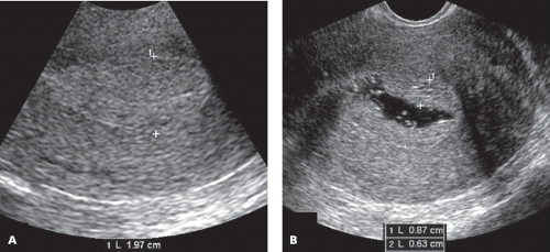 Endometrium | Obgyn Key