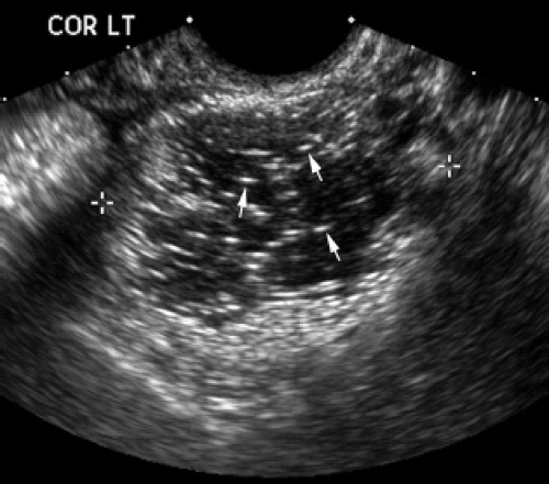 Ovaries and Adnexa | Obgyn Key