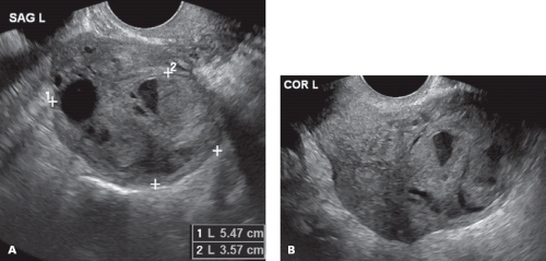 Ovaries and Adnexa | Obgyn Key