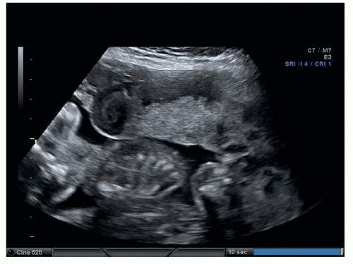 Placental Abnormalities | Obgyn Key