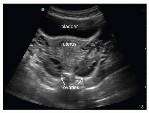 Ultrasound in Obstetric Emergencies | Obgyn Key