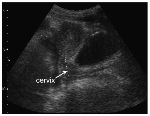 Ultrasound in Obstetric Emergencies | Obgyn Key