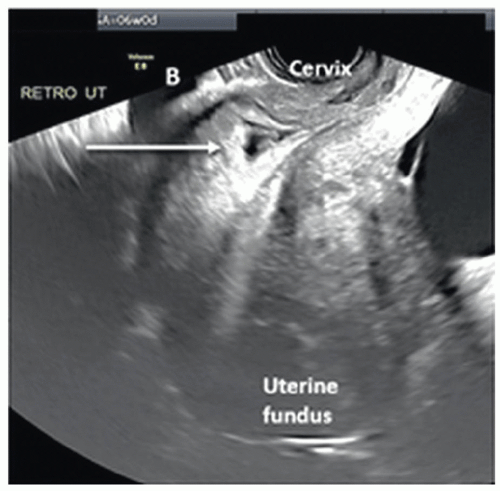 Cesarean Scar Pregnancy: Diagnosis and Management | Obgyn Key