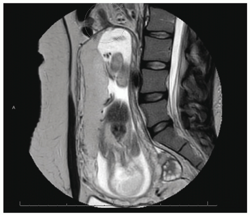 Uterine Defect Repair in an Ongoing Pregnancy | Obgyn Key
