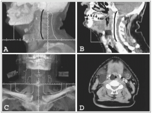Oropharynx and Hypopharynx | Oncohema Key