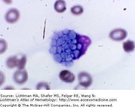 Lymphocytes and Plasma Cells | Oncohema Key