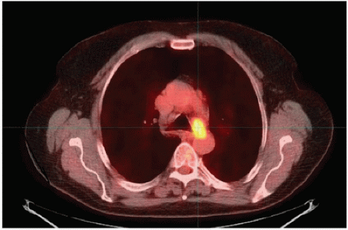 Cervical Mediastinoscopy | Oncohema Key
