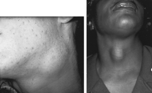 NONTHYROIDAL ANTERIOR CERVICAL NECK MASSES | Oncohema Key