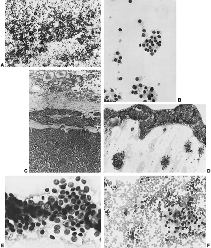 THYROID NEEDLE ASPIRATION AND BIOPSY | Oncohema Key