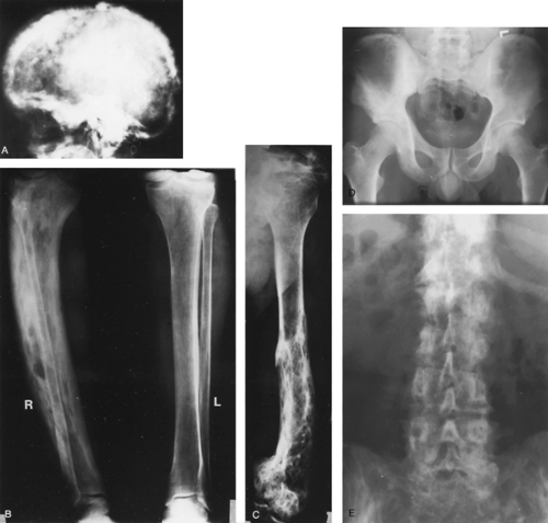 PAGET DISEASE OF BONE | Oncohema Key