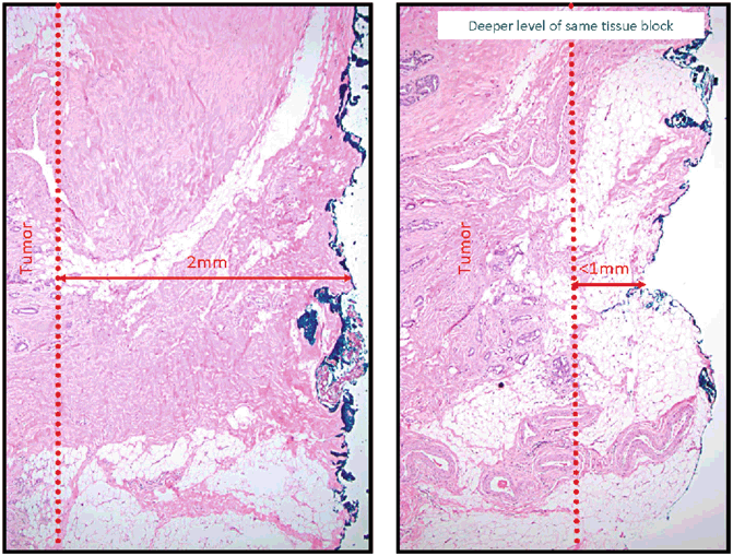 Extent and Role of Margin Control for DCIS Managed by Breast-Conserving ...