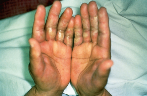 Dermatologic complications of cancer chemotherapy | Oncohema Key