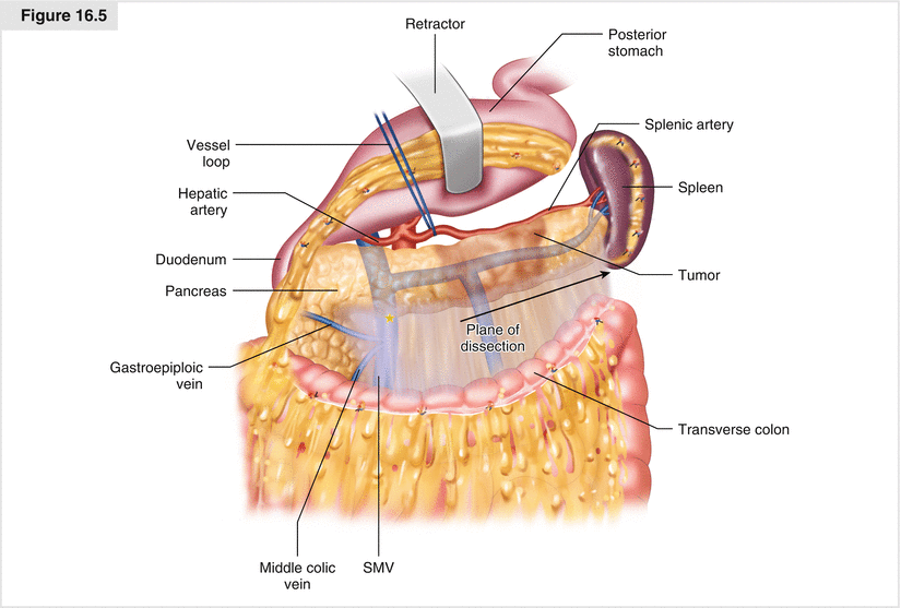 Open Distal Pancreatectomy | Oncohema Key