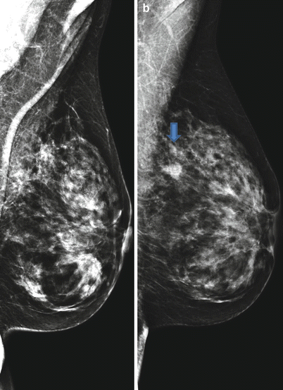 Indications for Three-dimensional (3D)/Digital Breast Tomosynthesis ...
