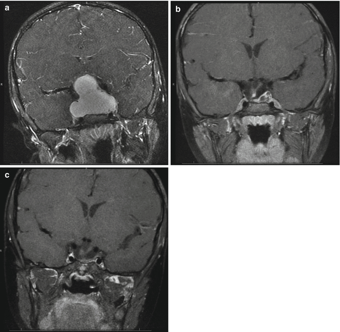 Craniopharyngioma | Oncohema Key