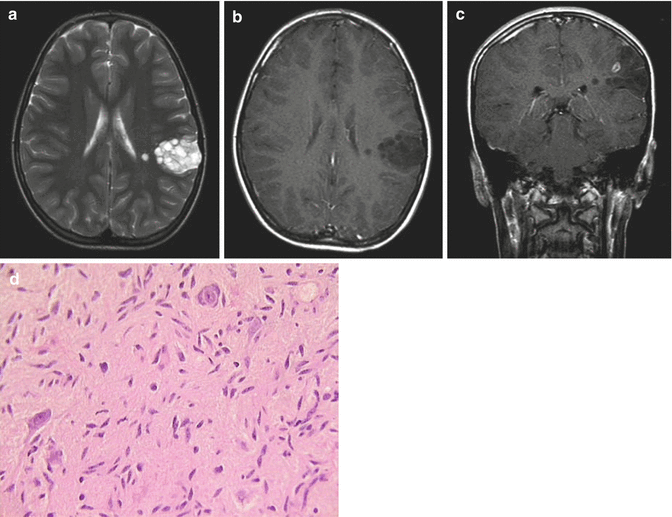 Neuronal Tumors | Oncohema Key