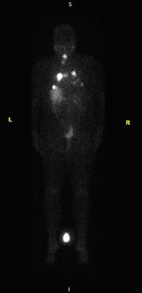 Treatment of Recurrent/Metastatic Thyroid Cancer with Radioactive ...