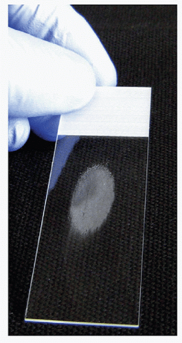 The Cytologic Approach to Diagnosis of Thyroid Pathology—Technical ...
