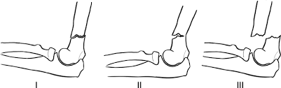 Pediatric Elbow Injuries | Pediatric Emergency Playbook