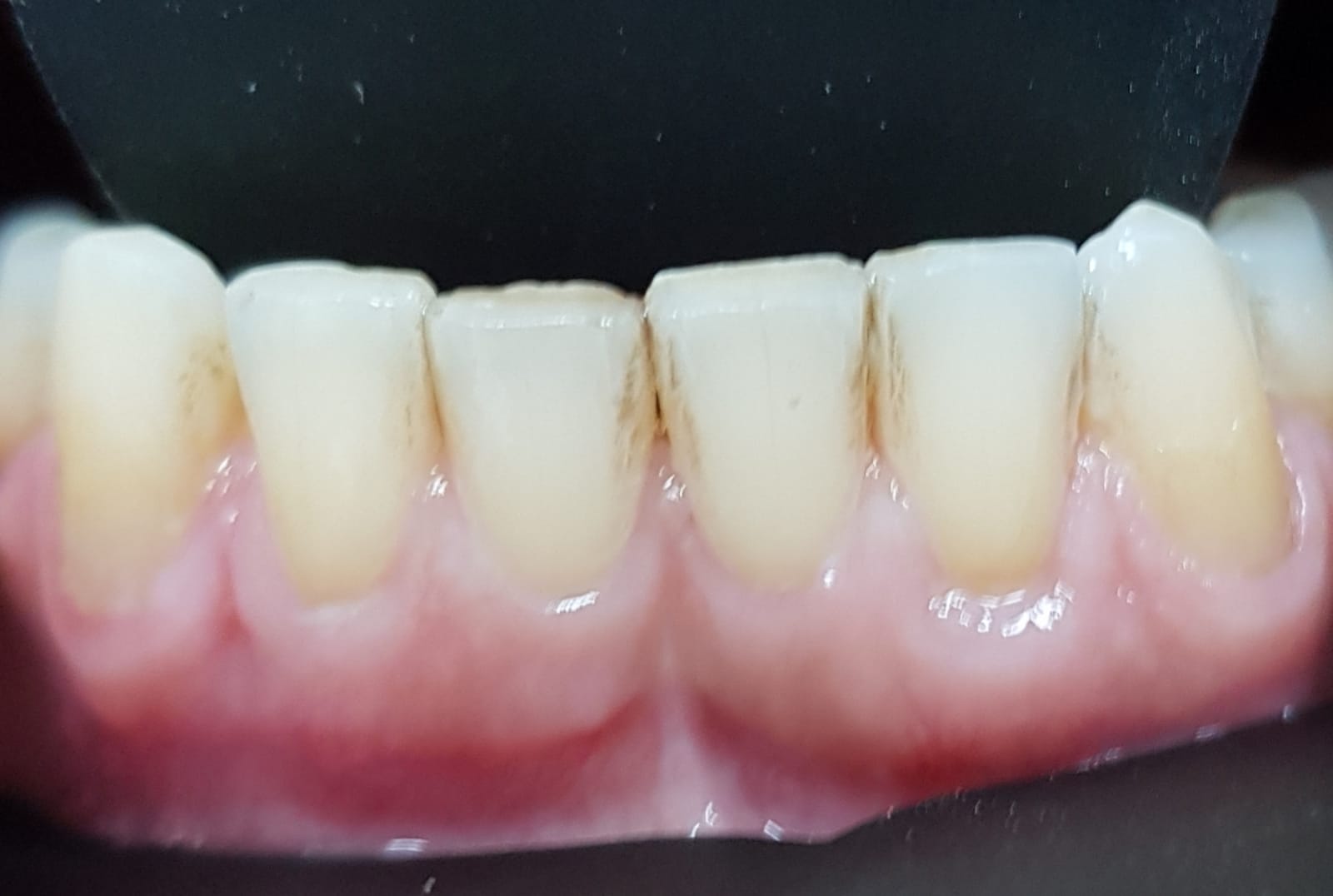 Great Results From Recession Coverage Procedure - PerioHome