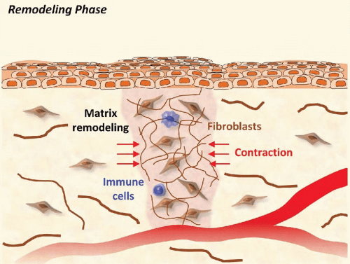 Wound Healing: Normal and Abnormal | Plastic Surgery Key