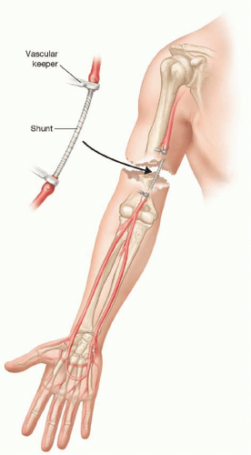 Replantation Strategies of the Hand and Upper Extremity | Plastic ...